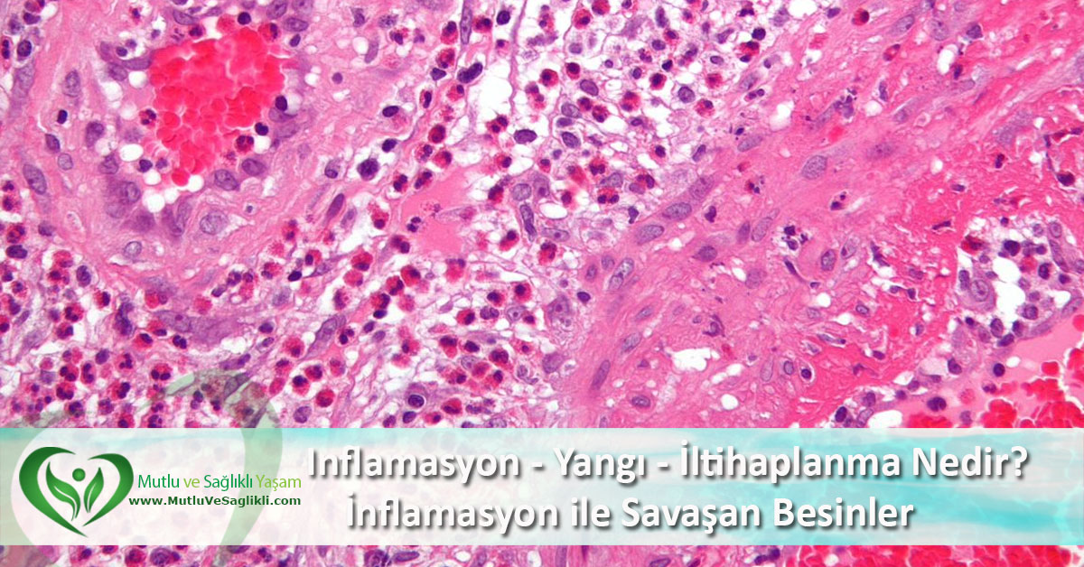 Inflamasyon - Yangı - İltihaplanma Nedir? İnflamasyon ile Savaşan Besinler